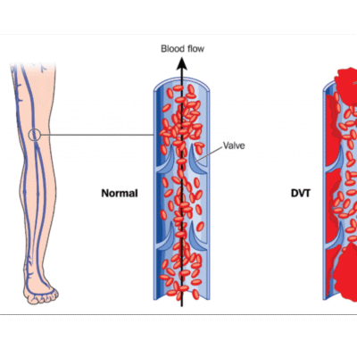 Beyond The Clot Understanding The Role Of Collateral Circulation In