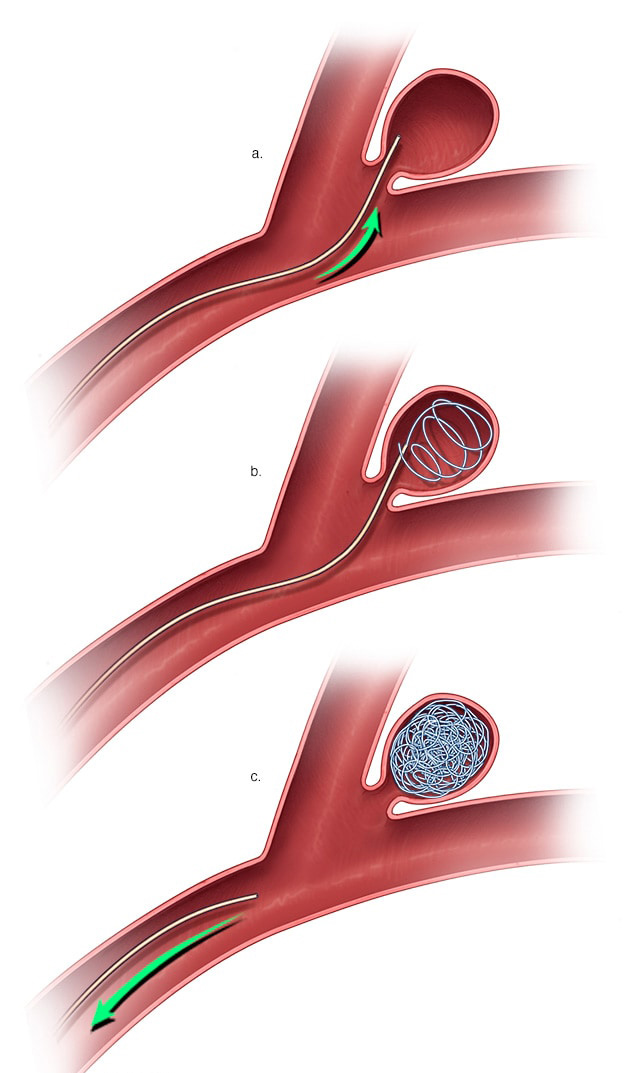 Device Selection for Complex Aneurysms: Flow Diversion vs Coiling vs ...